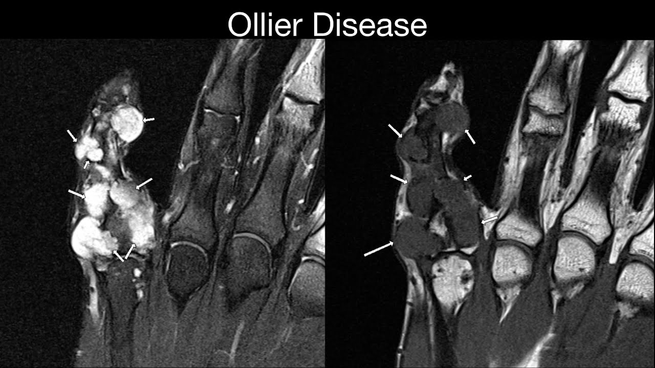 Ollier Disease - YouTube