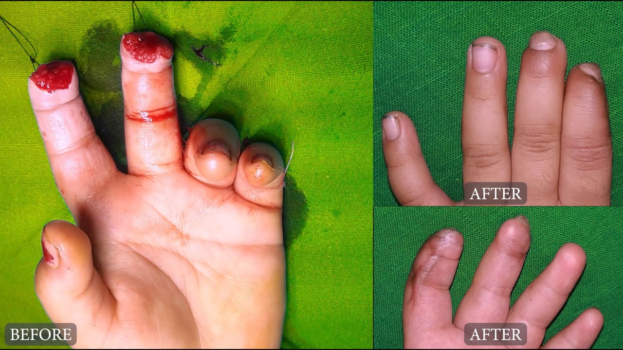 BIKE CHAIN MULTIPLE FINGER TIP INJURIES RECONSTRUCTED BY NEUROVASCULAR ...