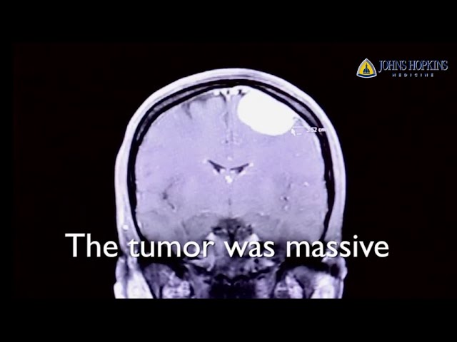 Right Parietal Convexity