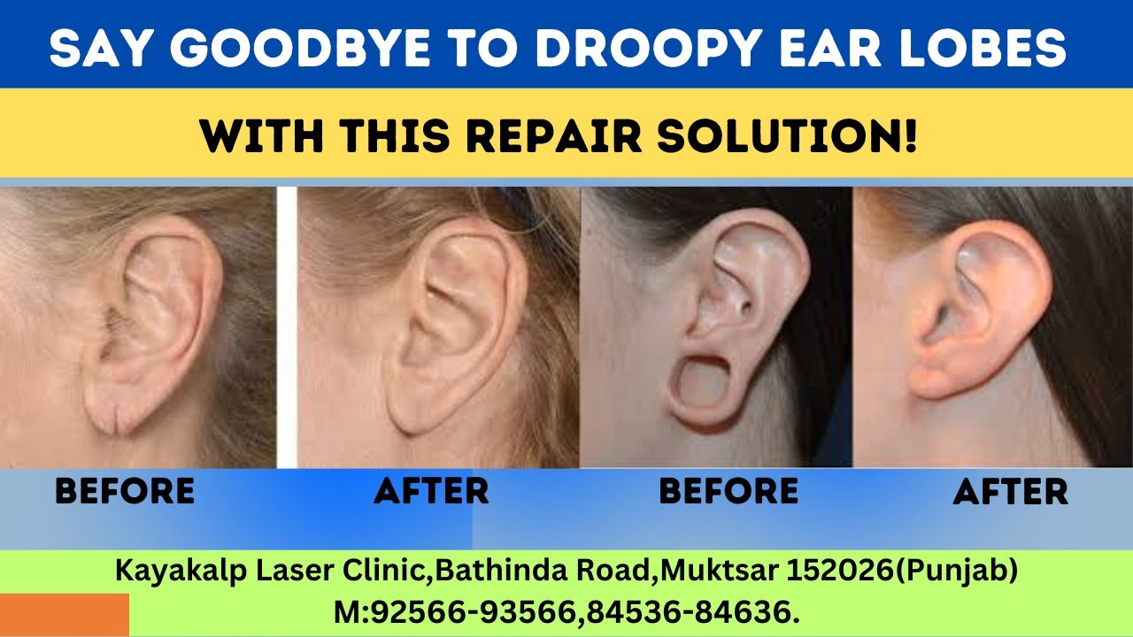 Say Goodbye To Droopy Ear Lobes With This Repair Solution! - YouTube