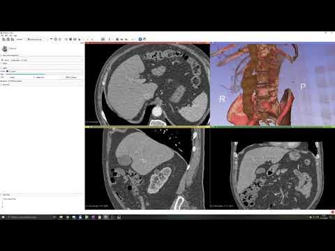 3D Slicer Tutorial #7: Surface vs Volume Rendering - YouTube