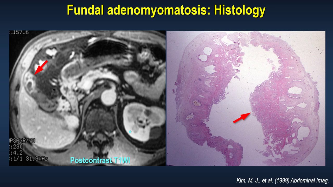 Characteristic radiological signs of gallbladder adenomyomatosis ...
