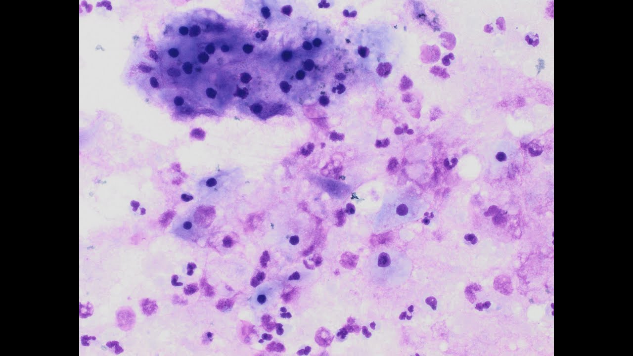 Diagnostic Cytopathology cases - YouTube