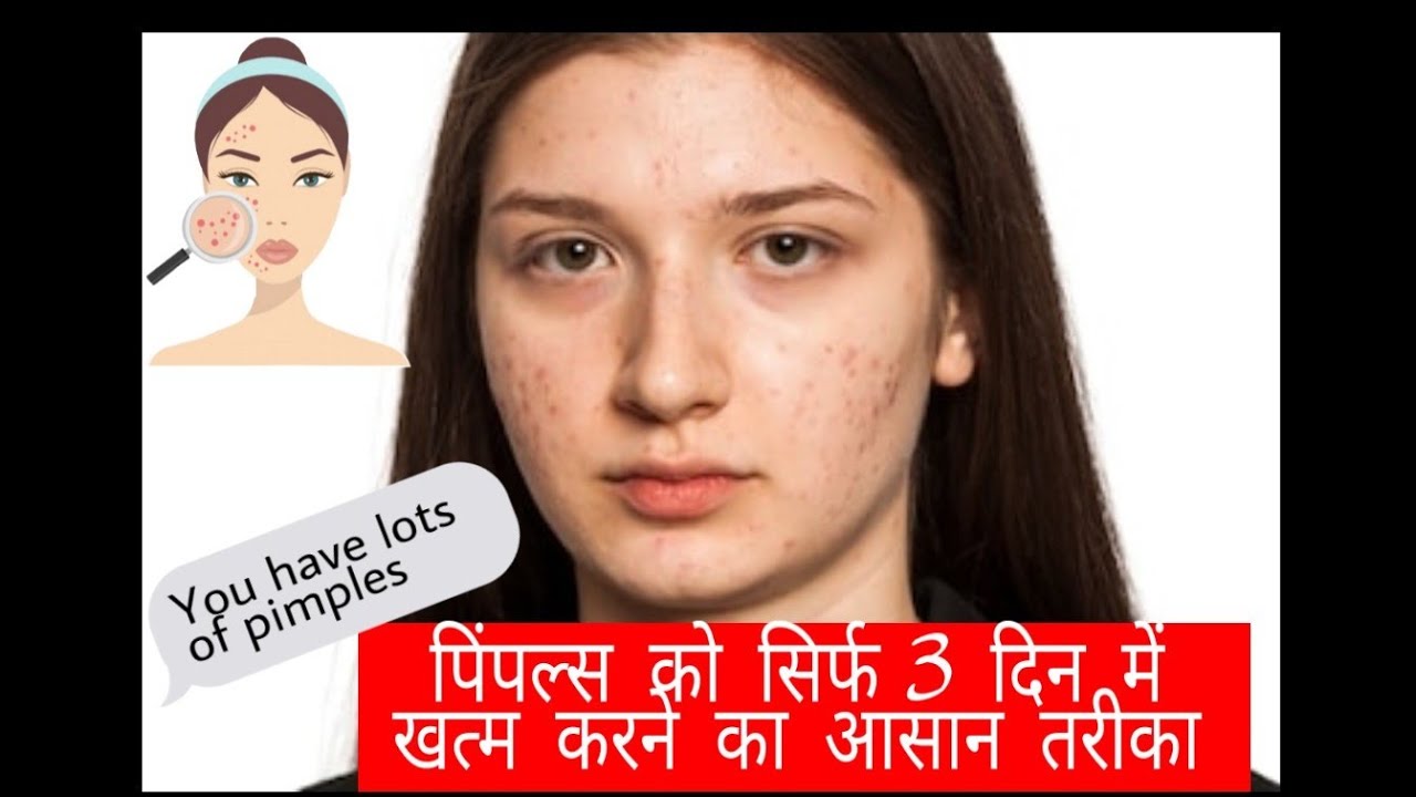 How To Remove Pimples At Home | Remove Pimples & Acne At Home | Best ...