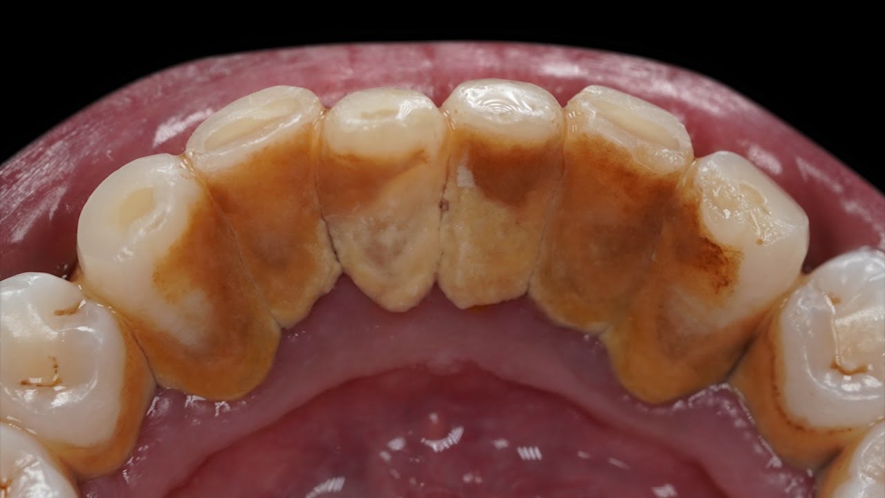 36 yo. Male's Teeth | Scaling Tartar | Calculus | Karang Gigi | Dentist ...
