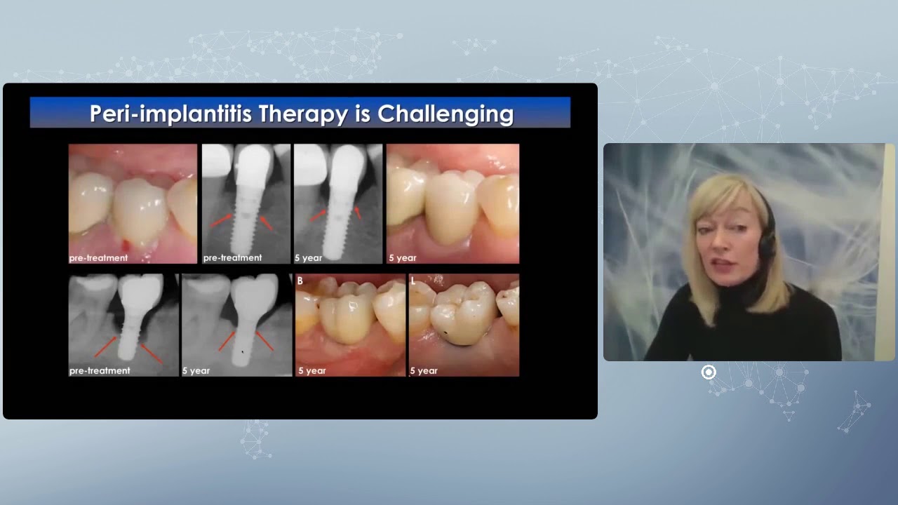 Geistlich Webinar Periimplantitis - Prof Lisa Heitz Mayfield - YouTube