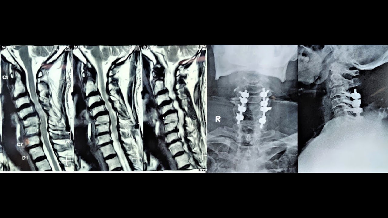 CERVICAL SPINE LATERAL MASS FIXATION/STABILISATION-MICROSURGERY-dr ...