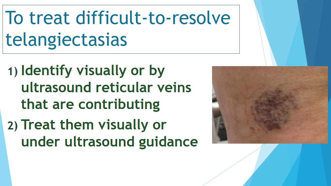 Treatment of difficult to resolve telangiectasias - YouTube