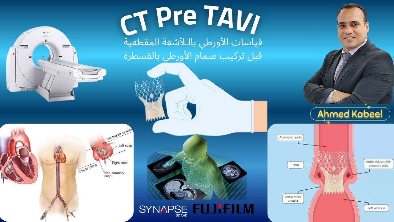 CT TAVI and Aortic Measurements قياسات الأورطي بالـلأشعة المقطعية قبل ...