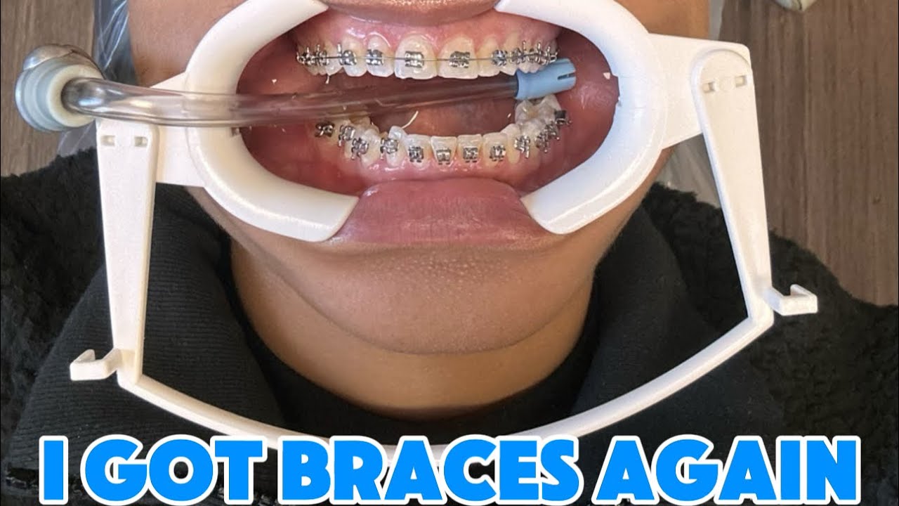 I GOT BRACES AGAIN !!!! - YouTube