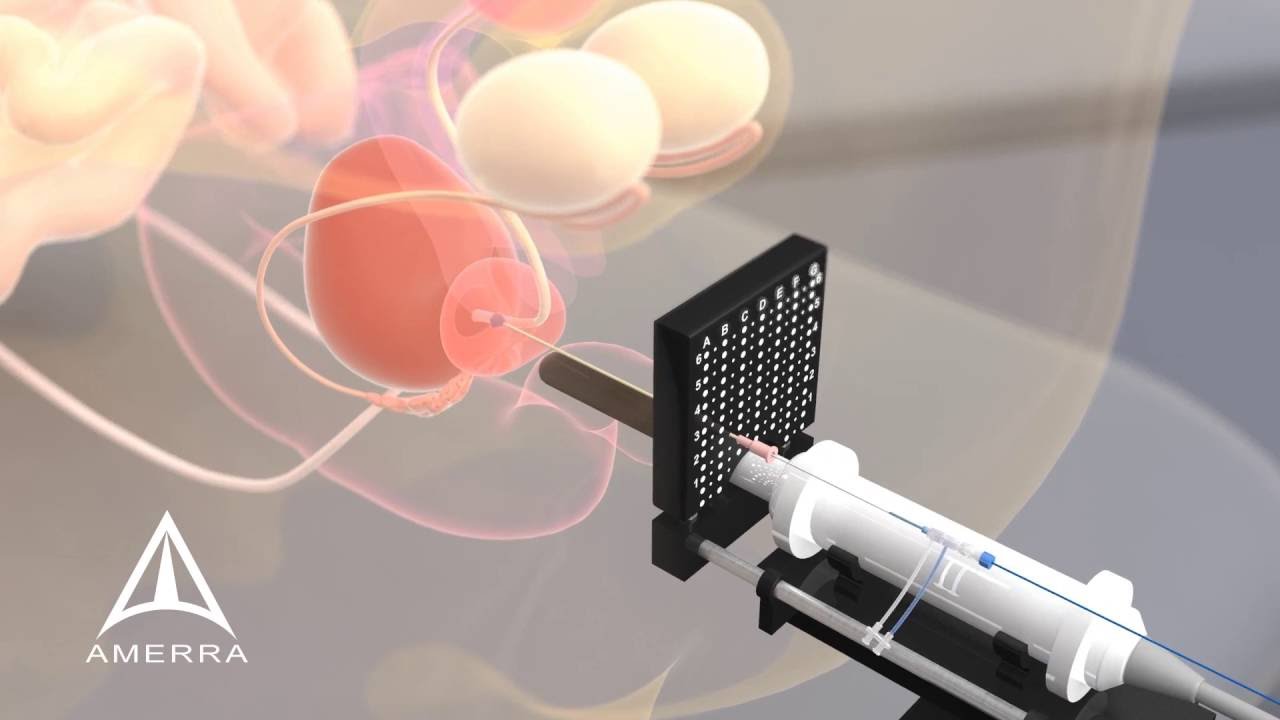 Nanospectra - Aurolase - 3D Medical Animation - YouTube