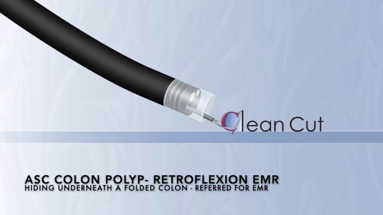 Colonoscopy: Retroflexion EMR in Ascending Colon UnderWater - YouTube