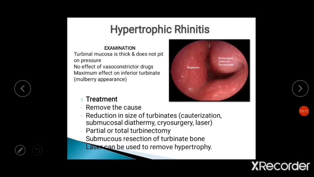 Acute and Chronic Rhinitis - YouTube