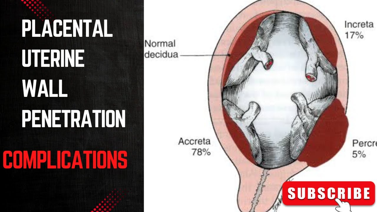 Placenta damage uterus complications - YouTube