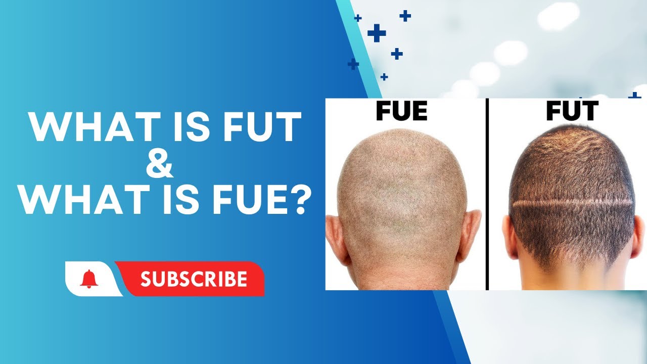 What is FUT & what is FUE - YouTube