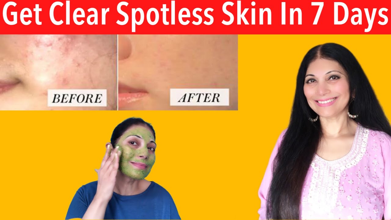 How to Get Rid Of Acne And Pimples Naturally & Fast - Get Clear Glowing ...