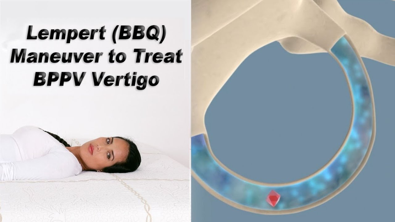 Lempert (BBQ) Maneuver to Treat BPPV Vertigo - YouTube