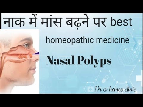 Nasal Polyps की !! homeopathic medicine - YouTube