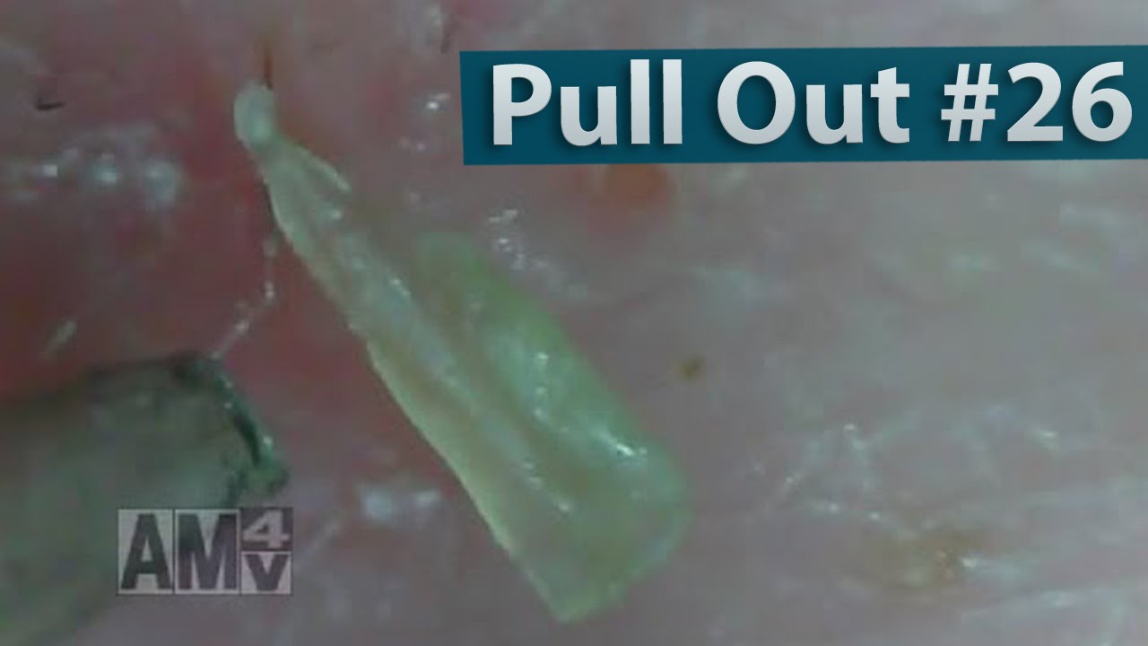 #26 Pull Out Blackheads Close up - Blackheads Removal - YouTube