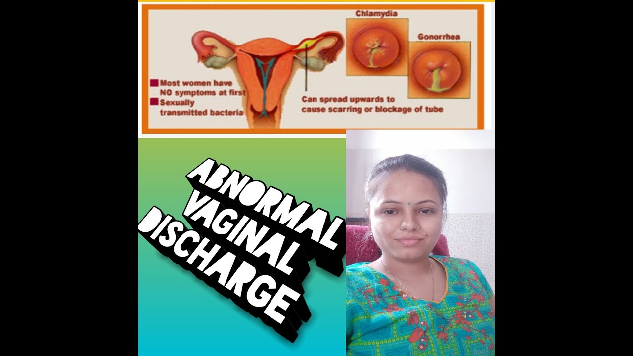 Abnormal Vaginal Discharge Color