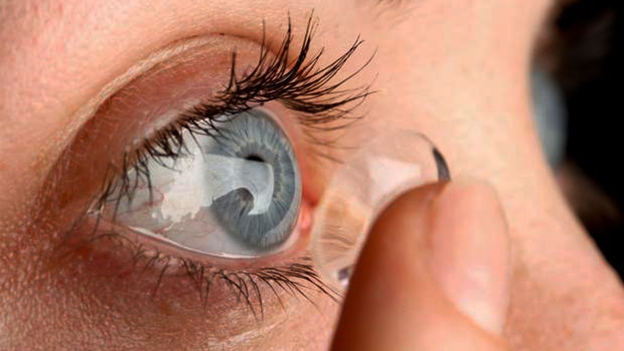 Doctors Remove 27 Contact Lenses Lodged In Woman’s Eye - YouTube