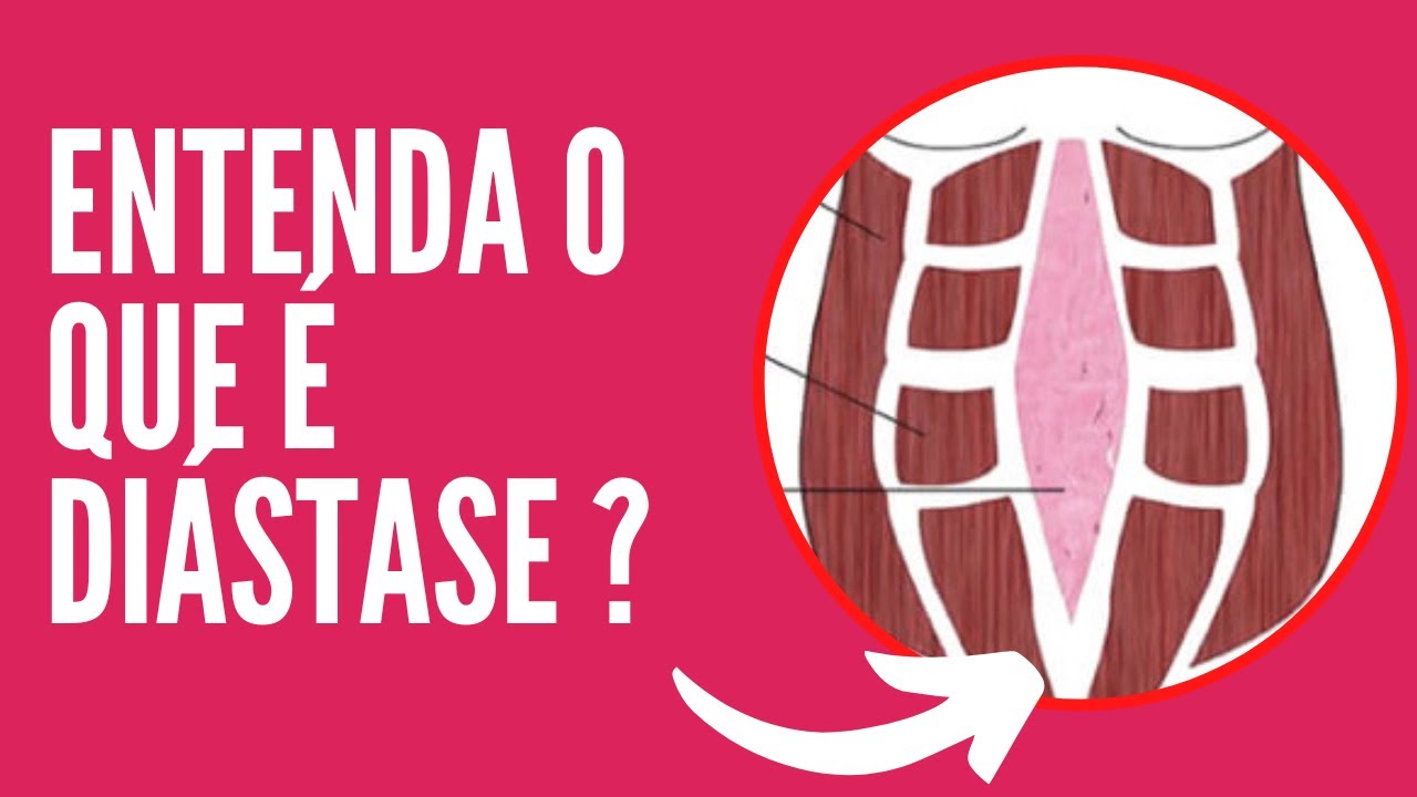 O que é Diástase de forma simples. - YouTube