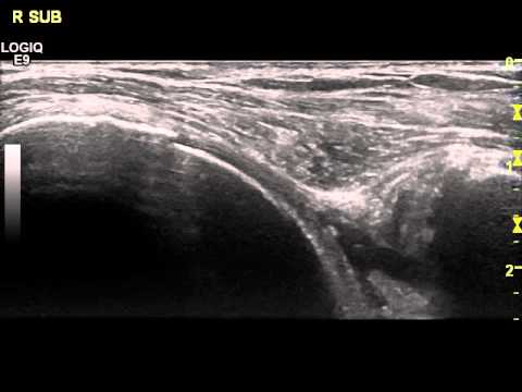 Ruptured Subscapularis: Transverse Image - Dr Peter Resteghini - YouTube