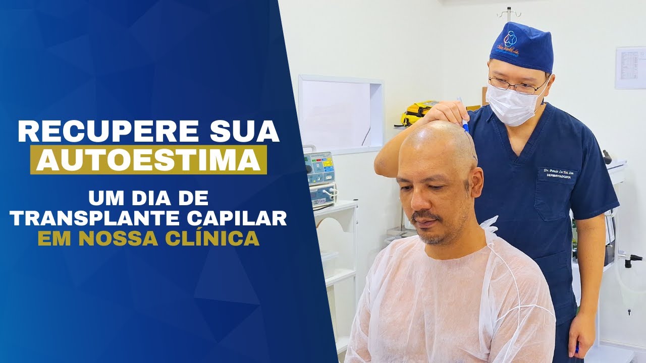 Transplante Capilar FUE em Sorocaba-SP 🤩 #drpaulolu #transplantecapilar ...