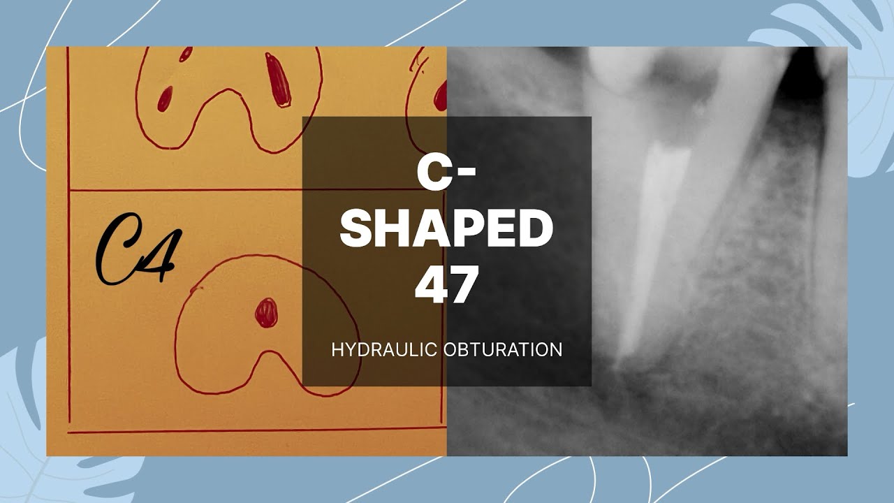 C-SHAPED root canal treatment LR7 C4 hydraulic obturation - YouTube