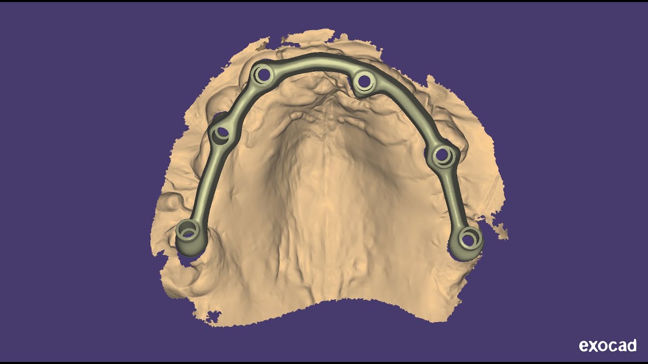 Upper all on 6 titanium bar designing for SMU implants in EXOCAD ...