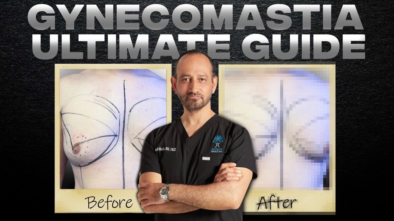 Gynecomastia: The Ultimate Guide to Understanding and Treating - YouTube