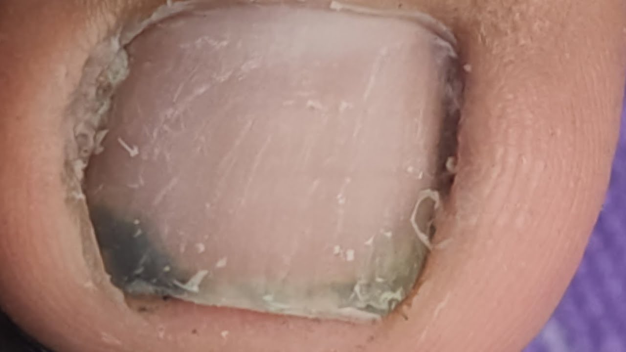 The buried soil on the edge of the nail stinks. - YouTube