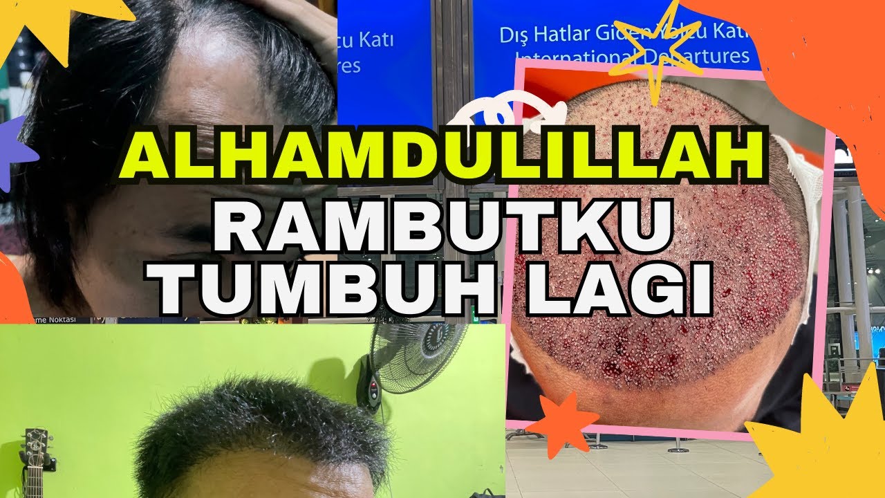 Proses Pertumbuhan Hasil Tanam Rambut | Hair Transplant - YouTube