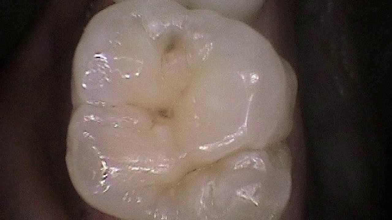 EQUIA: Microdentistry Procedures with Dr. James C. Burden, DMD, FAGD ...