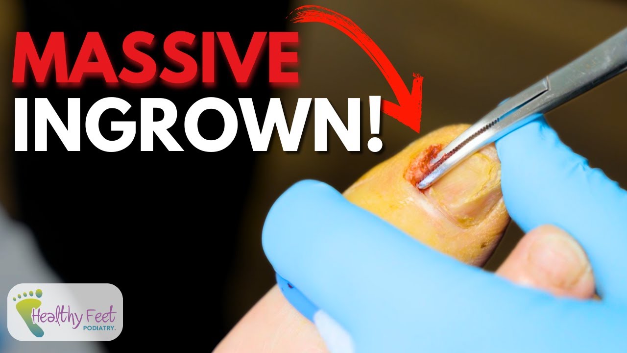 Runner’s Ingrown Toenail Removal + What Causes Nail Creases | Dr. Todd ...