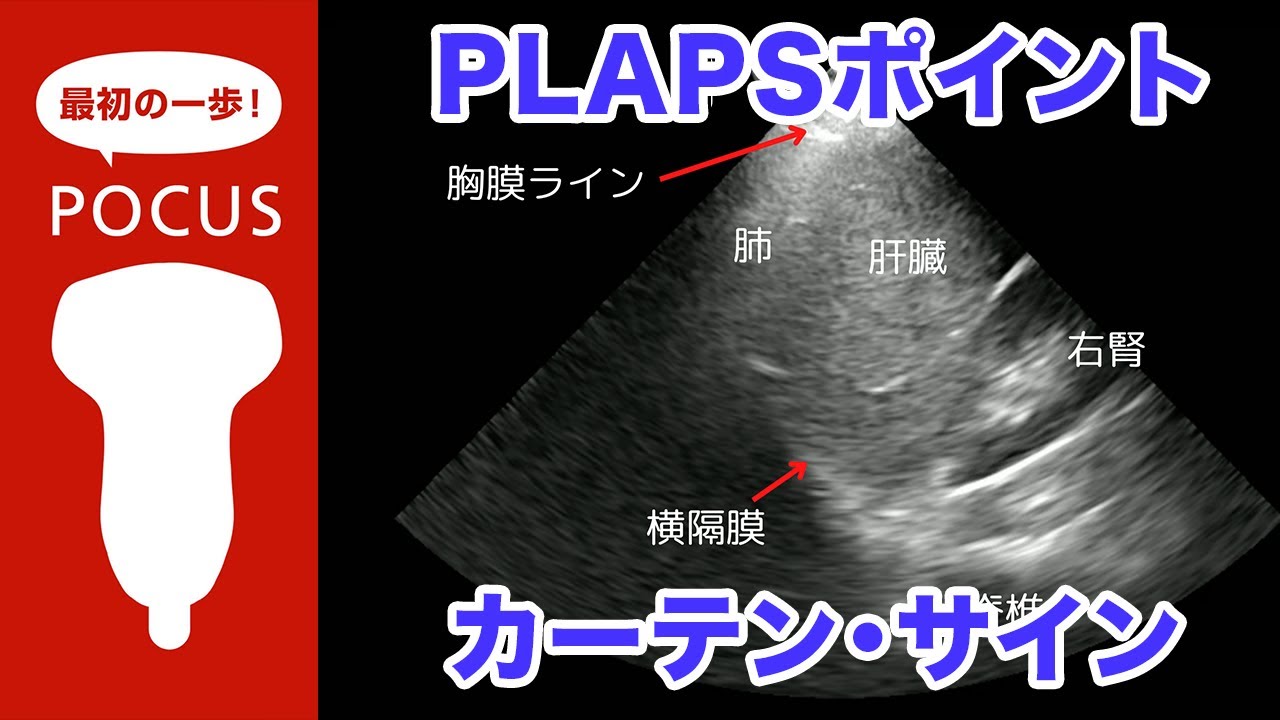 PLAPSポイント・カーテンサイン(curtain sign)【POCUS・肺ポイントオブケア超音波】 - YouTube