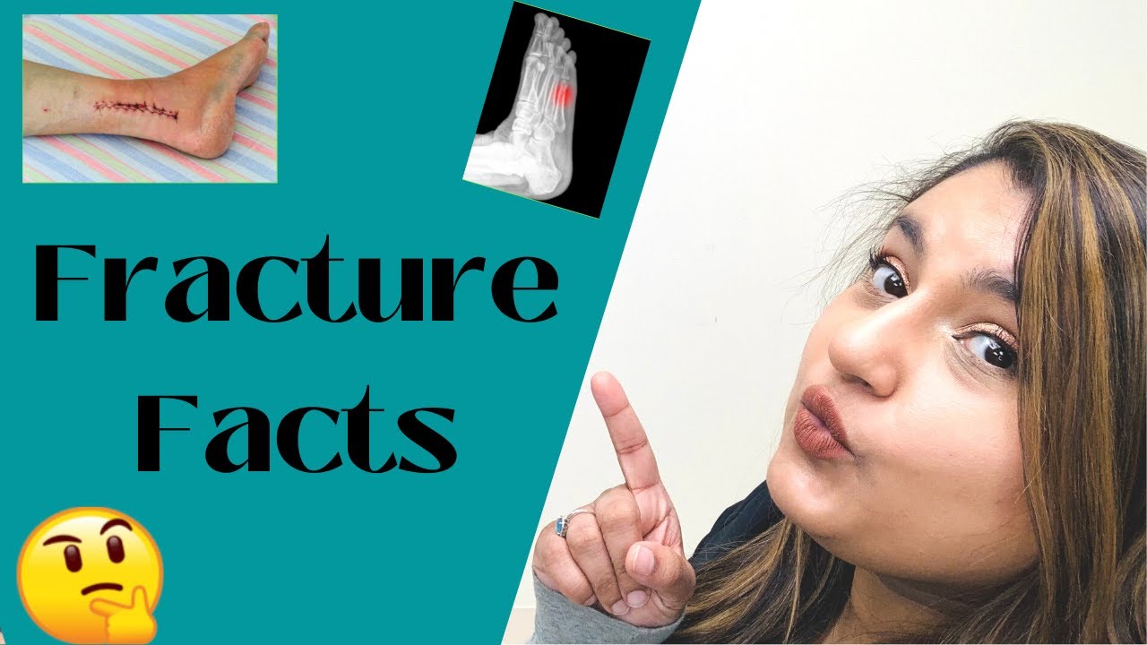 Fracture Facts - YouTube