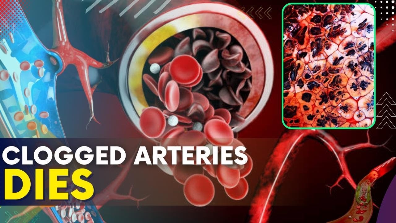 Clogged Arteries dies! If you have This in your house reverse clogged ...