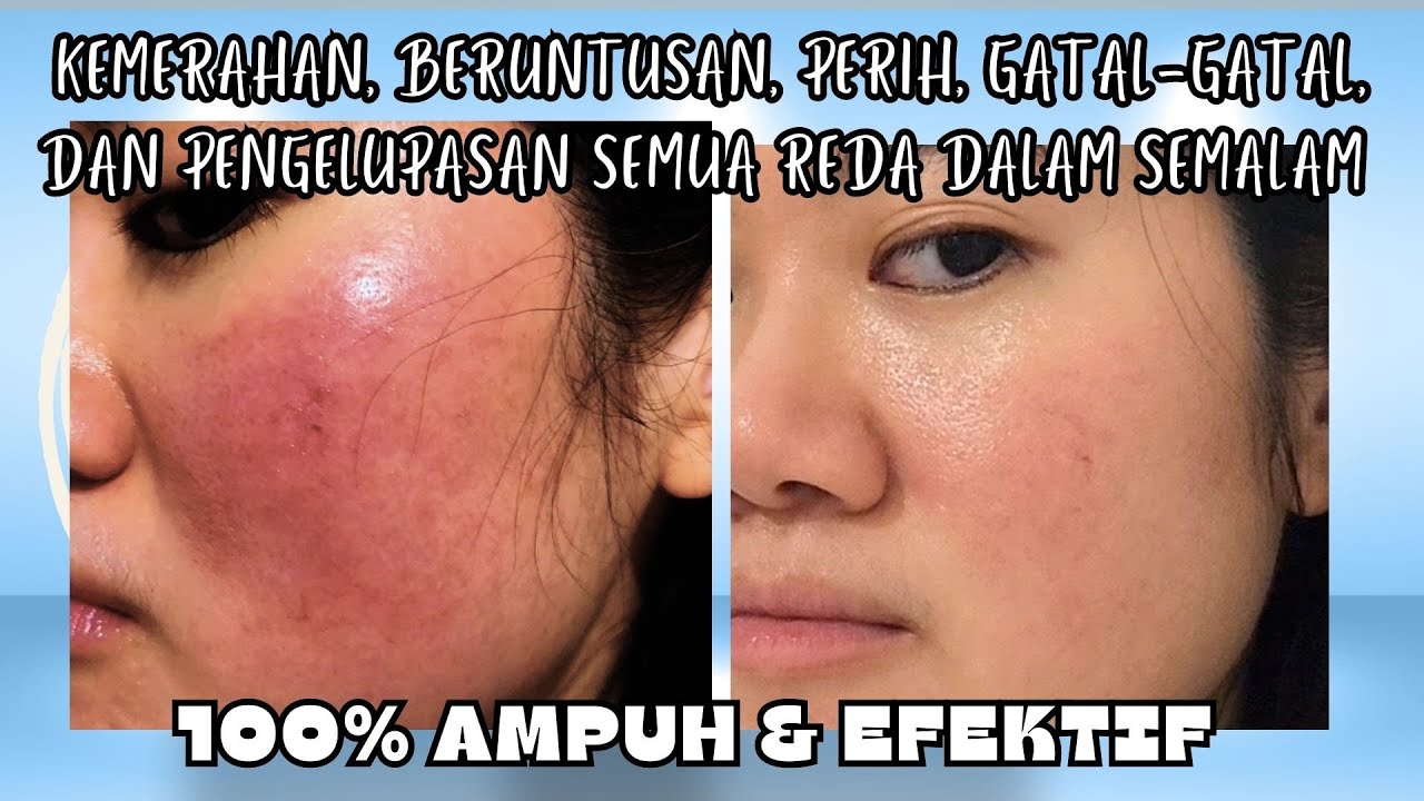 MENGATASI KEMERAHAN DAN IRITASI PADA WAJAH DALAM SEMALAM - YouTube
