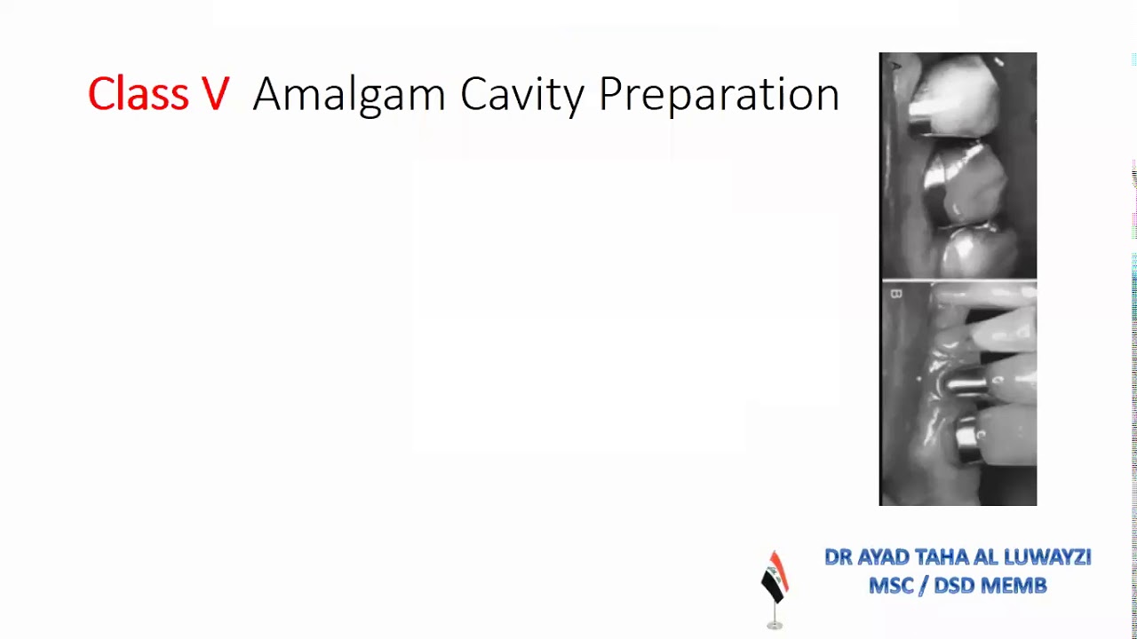 Class V Amalgam Cavity Preparation #third_stage #operative #dentistry ...