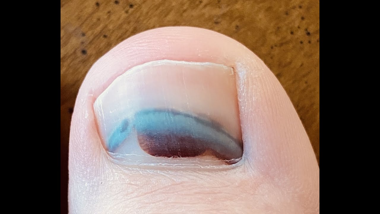 Toenail Time Lapse (9 Month Recovery) - YouTube