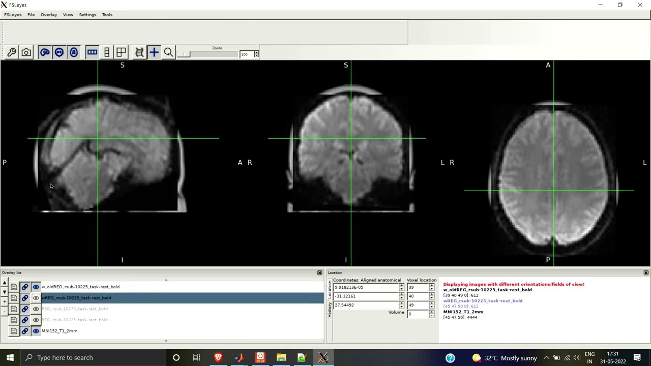 Normalization to the MNI Space and Smoothing | SPM | Resting-State fMRI ...