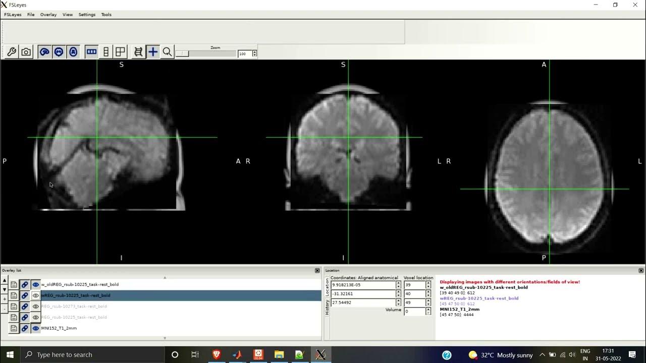 Normalization to the MNI Space and Smoothing | SPM | Resting-State fMRI ...