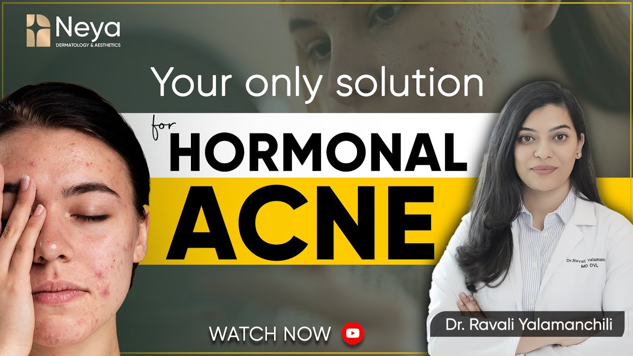 Hormonal acne treatment | Dermatologist in Hyderabad | Neya Clinic - YouTube