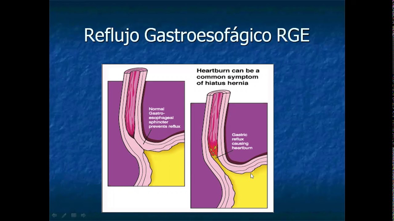 PATOLOGIA DE ESOFAGO - YouTube