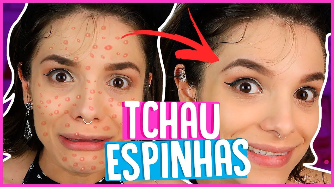 COMO ACABAR DE VEZ COM AS ESPINHAS EM CASA! - YouTube