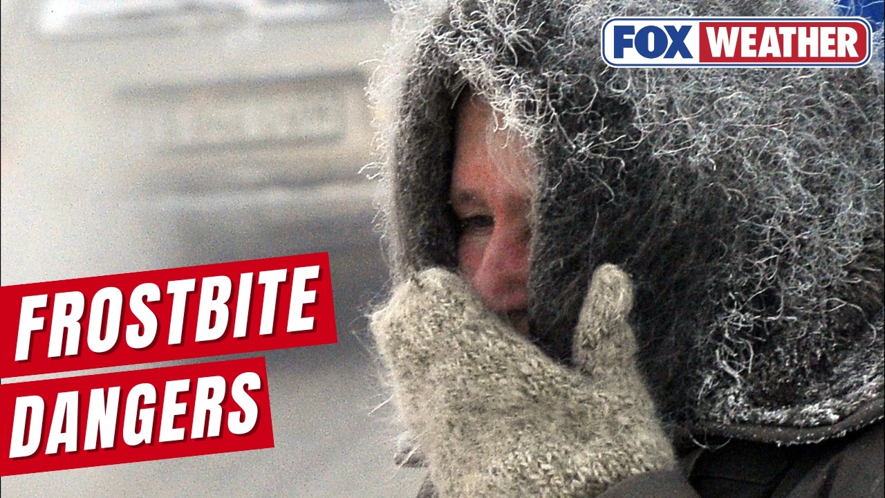 Doctor Details Dangers Of Frostbite As Extreme Cold From Arctic Air ...