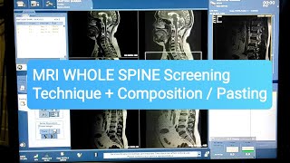 Spinal Cord MRI scan protocol, positioning and planning.