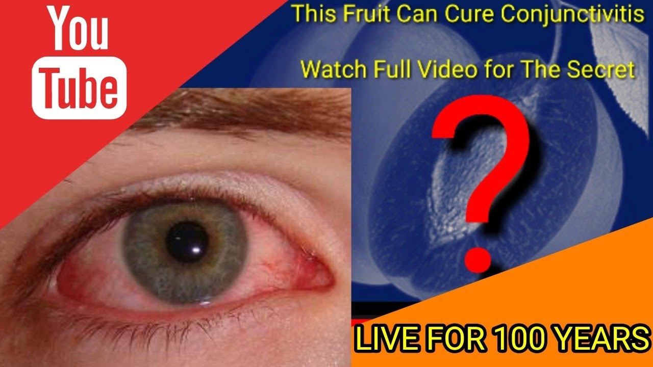 Conjunctivitis | How to prevent Conjunctivitis | Conjunctivitis Cure ...