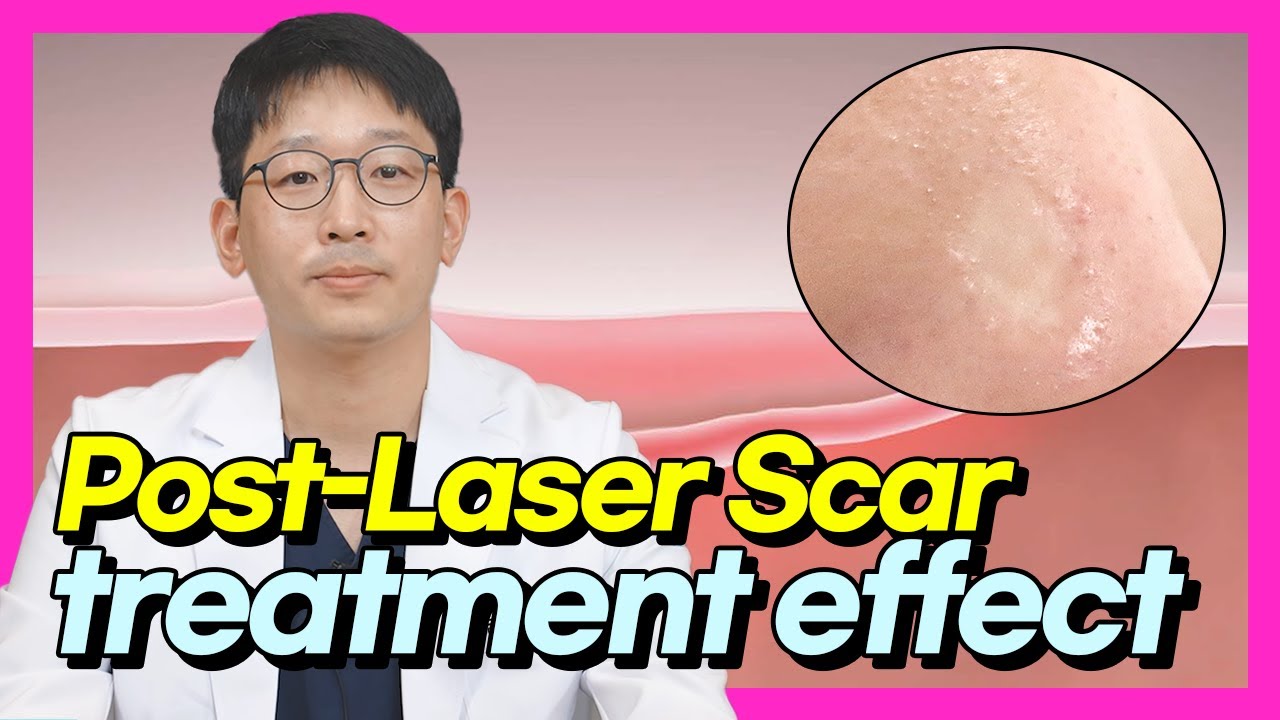 Laser Treatment Gone Wrong? Pitted Scars Successfully Improved - YouTube